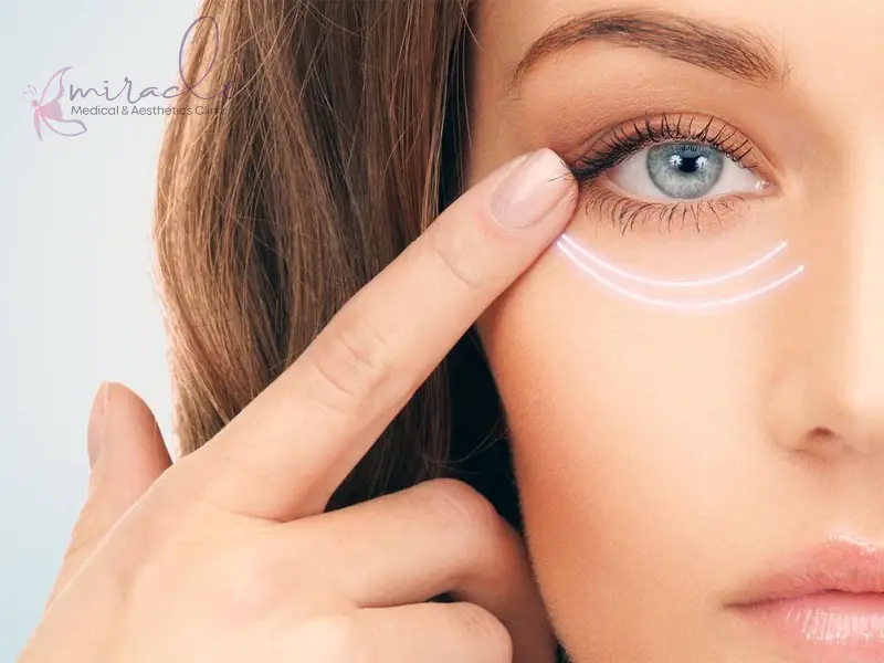 PRF Under Eyes in Brampton - Miracle Medical & Aesthetic Clinic